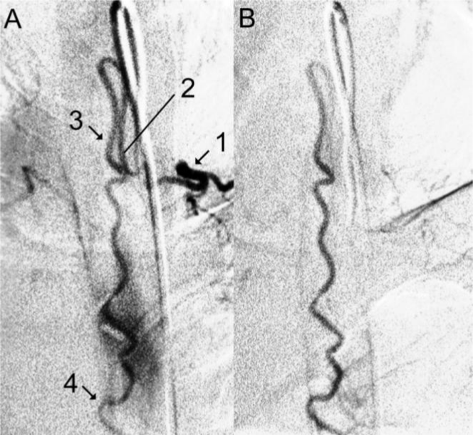 Anterior Spinal Artery Angiogram