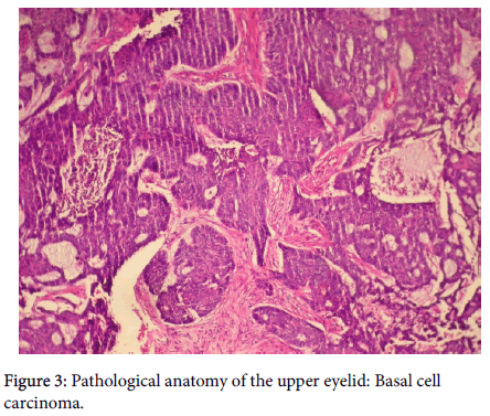 Xeroderma Pigmentosum- Diagnosis and Treatment of Two Different Ocular ...